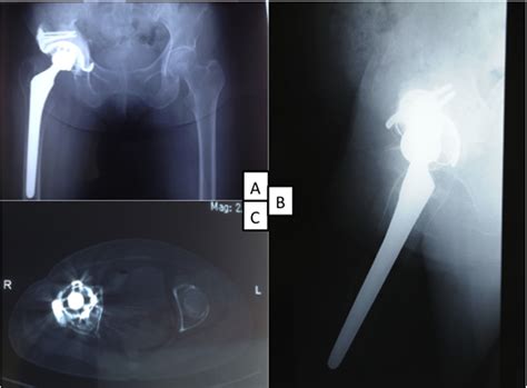 Figure 1 From Iliopsoas Impingement After Revision Total Hip