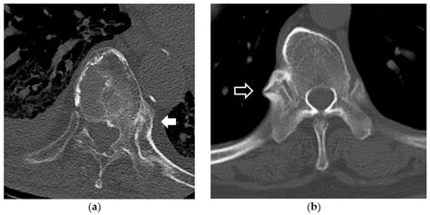 Diffuse Idiopathic Skeletal Hyperostosis Foot