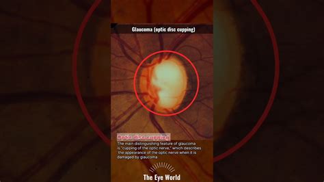 Optic Nerve Cupping What You Must Know To Protect Your Sight Researchhub Blog