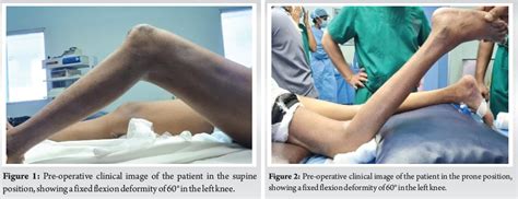 Radical Posterior Release For Severe Flexion Contracture Of Knee