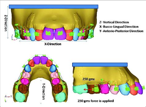 Finite Element Model With Brackets Full Dimensional Wire K Loop And Download Scientific