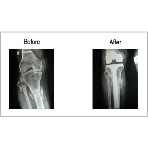 Old Fracture Of Spin Bone With Osteoarthritis Dr Samir Nanavati