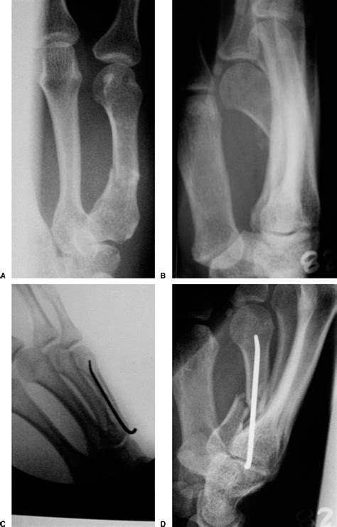 Figure 1 From Comparison Of Intramedullary Nailing Versus Plate Screw Fixation Of Extra