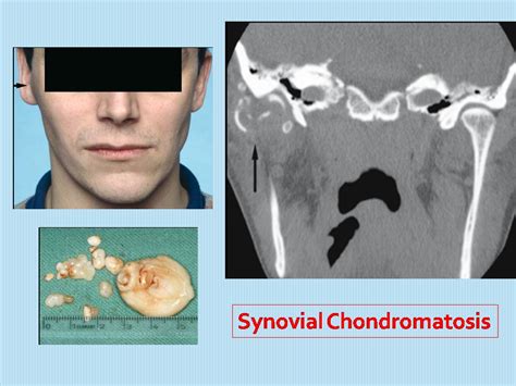 Dentistry And Medicine The Tempromandibular Joint Tmj Normal Anatomy And Pathology With