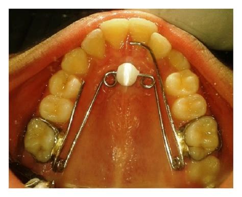 Design Of Modified Quadhelix Appliance With A Roller A Construction Download Scientific