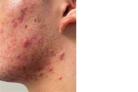A Teenager With Facial Papules And Pustules Medicine Today