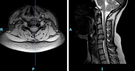 Hernia Discal Hernia Discal Cervical ¿hay Que Operarse Advansur
