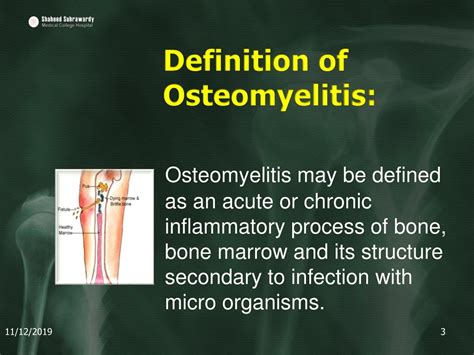 Ppt Osteomyelitis At Shaheed Suhrawardy Medical College Hospital