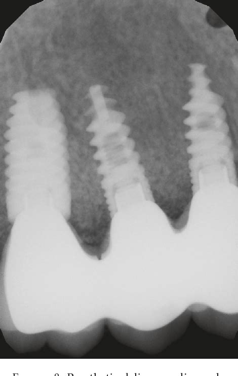 Figure 1 From Immediate Implant Placement By Interradicular Bone