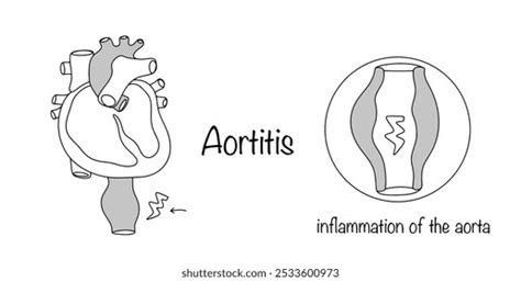 Inflammatory Process That Develops Joint Capsule Stock Vector Royalty Free 2550386615