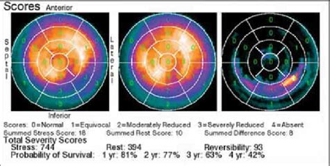 Defects And Reversibility Of Perfusion On Polar Maps Of 99m