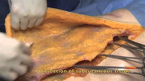 Hands On Cadaver Dissection Anterior Component Separation Youtube