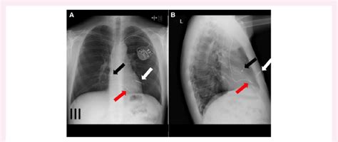 Left Sided Infraclavicular Dual Chamber Pacemaker With Implantable Loop