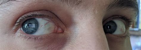 What Do Normal Eye Veins Look Like