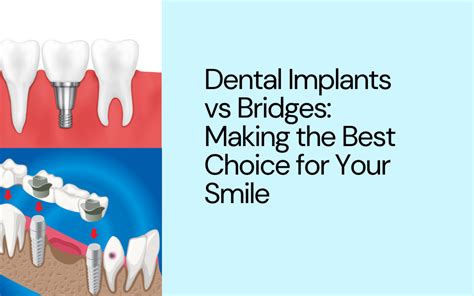 Dental Implants Vs Bridges Making The Best Choice For Your Smile