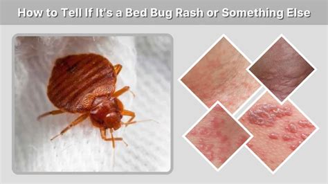 What Does A Bed Bug Rash Look Like Complete Identification Guide