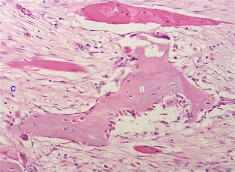 结缔组织骨化生 病理学