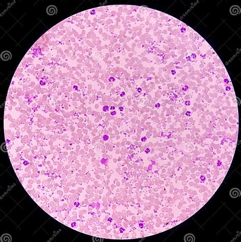 Essential Thrombocytosis Blood Smear Showing Abnormal High Volume Of