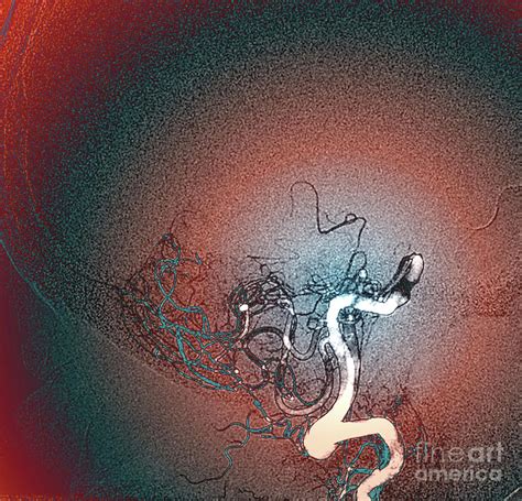 Ischaemic Stroke 1 By Science Photo Library