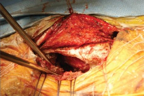 Intraoperative Image From Eyebrow Incision And Orbital Craniotomy