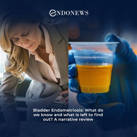 Bladder Endometriosis Current Knowledge And Future Directions Endonews