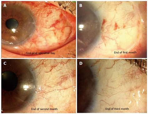 Human Amniotic Membrane Transplantation Different Modalities Of Its