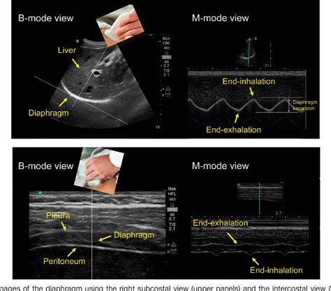 Diaphragm Function Ultrasound At Dylan Forwood Blog