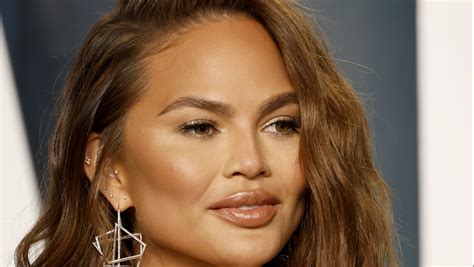 Chrissy Teigen Shares Hairline Lowering Procedure Details