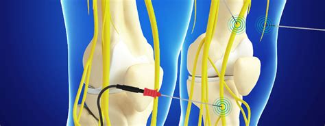 Genicular Nerve Ablation Coppell Genicular Nerve Ablation For Auto Accident Injuries