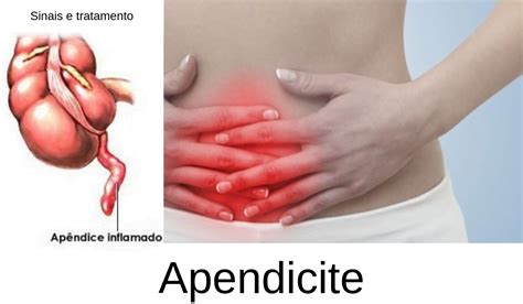 Apendicite Sintomas Causas E Tratamento