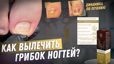Как вылечить грибок ногтей? / Динамика по лечению #динамика # ...