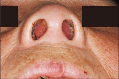 Nasal Septal Abscess With A Dental Origin A Case Report And A Review