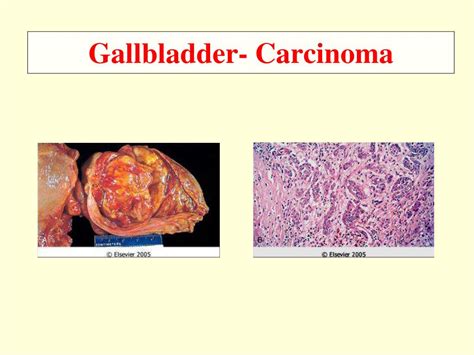 Ppt Mc Congenital Anomalies Abnormal Variants Of The Gallbladder Mc Folded Fundus