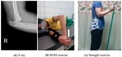Early Rehabilitation After Surgical Repair Of Medial And Lateral