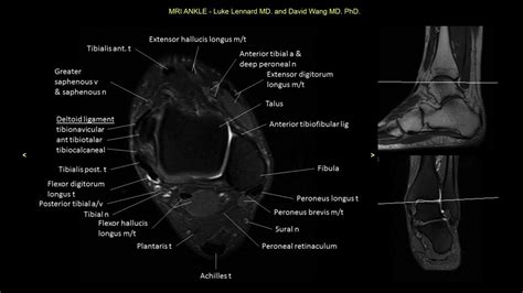 Ankle Mri Anatomy Atlas Youtube
