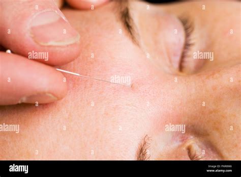 Acupuncture Needles As Fine As Hair Being Inserted Into The Forehead