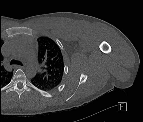 Ct Scan Of Left Shoulder With No Significant Soft Tissue Or Mediastinal