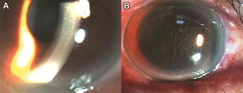 Fine Keratic Precipitates