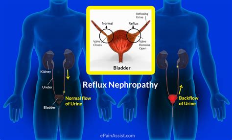 Nephropathy What Is Reflux Nephropathy