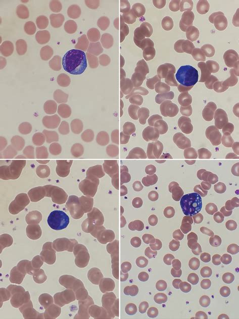Plasmacytoid Lymphocytes