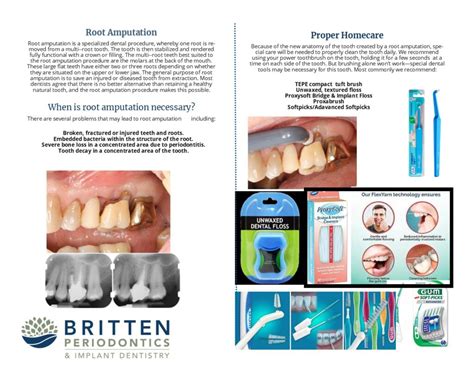 How You Can Care For A Tooth With A Root Amputation Britten Perio