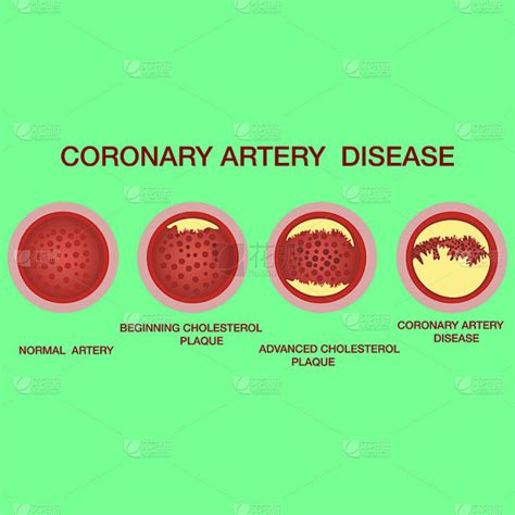冠状动脉疾病概念。健康且动脉狭窄且有斑块