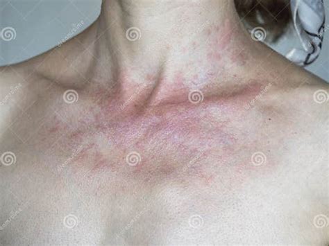 Solar Dermatitis Woman With Red Sunburned Skin Against Gray Background