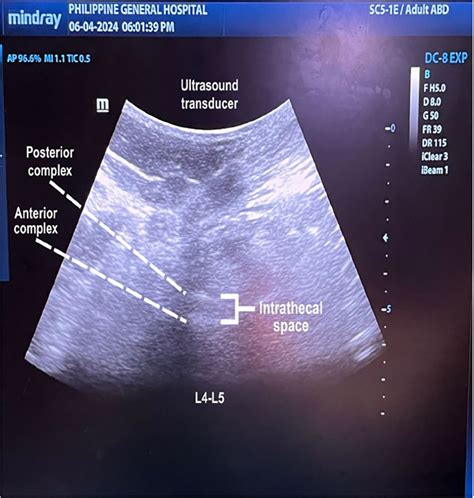 P233 Ultrasound Assisted Neuraxial Anesthesia In An Adult Patient With