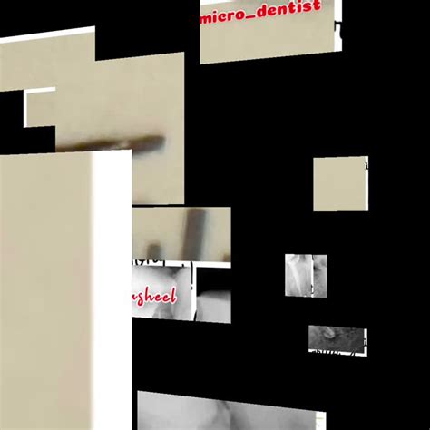 Dr Susheel Kumar On Linkedin Separatedinstrumentremoval