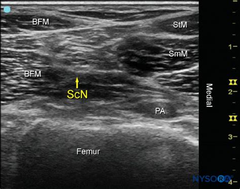 Bloc Du Nerf Sciatique Poplité Guidé Par Ultrasons Nysora