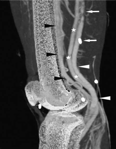 Role Of Computed Tomographic Angiography In The Detection And