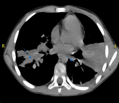 Computed Tomography Of Bilateral Bronchiectasisbronchiolectasis With