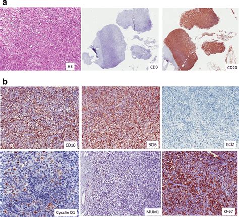 A Diffuse Proliferation Of Large And Atypical Lymphoid Cells He Download Scientific Diagram