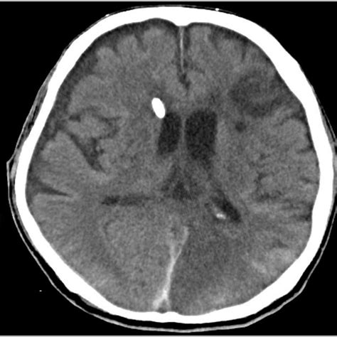 Computed Tomography Brain With Evd Traversing Through The Right Lateral